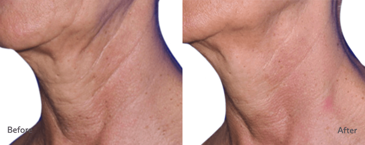 Transform Your Skin with Radio Frequency (RF) Skin Tightening — Skin Medex