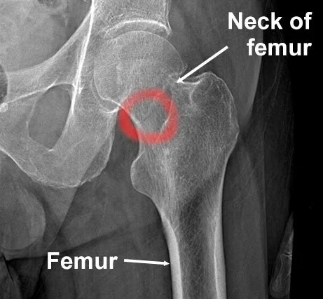 Understanding Femoral Stress Fractures: Diagnosis and Treatment Guide ...