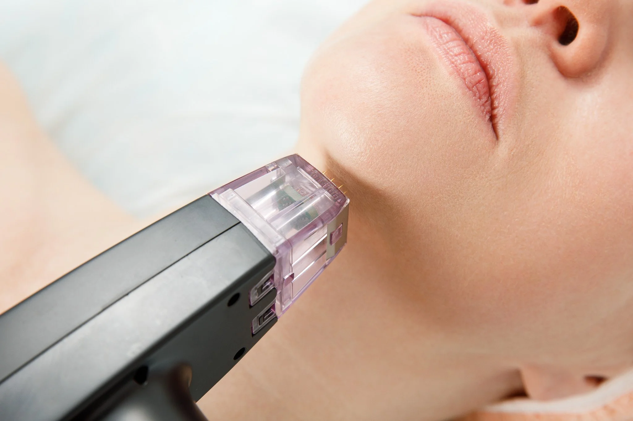 Morpheus8 Treatment in Myrtle Beach - All You Need To Know