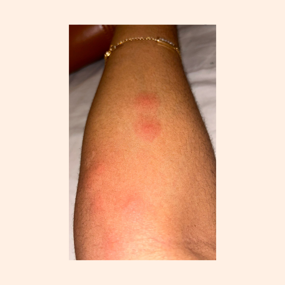 What Do Bed Bug Bites Look Like On Brown Skin Woman Infoupdate What Do Bed Bug Bites Look Like On Brown Skin Woman Infoupdate