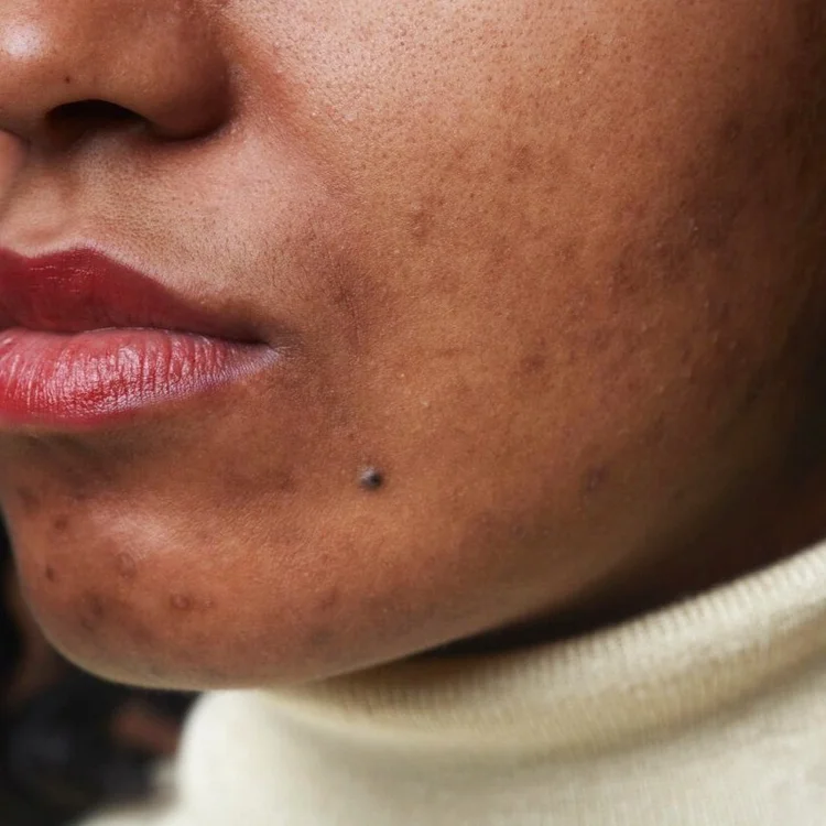 Skin Concerns — Black Skin Directory