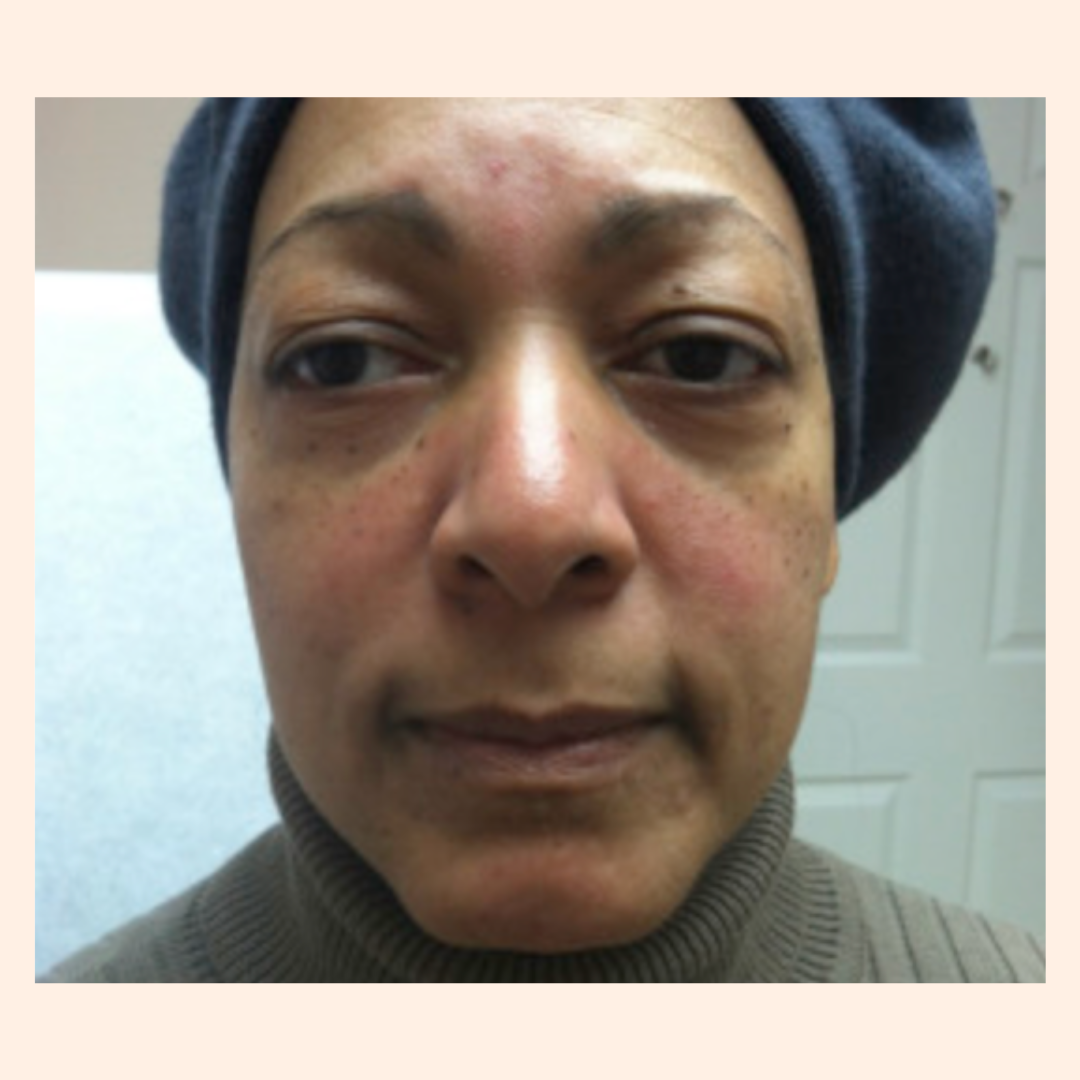 Everything You Need To Know About Black Skin and Rosacea — Black Skin ...