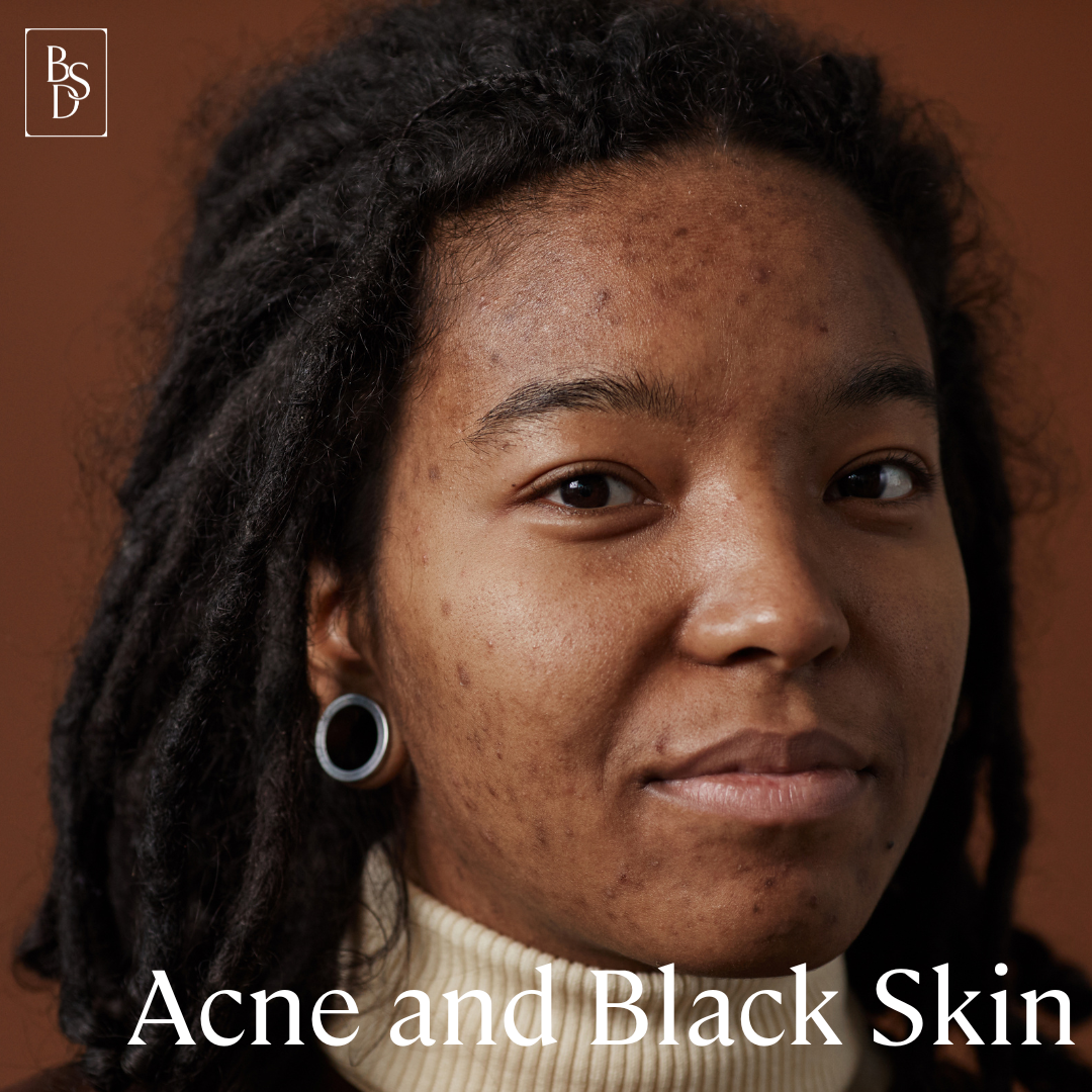 Acne And Black Skin Black Skin Directory Acne And Black Skin Black Skin Directory