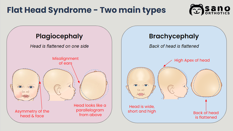 What you need to know about Flat Head Syndrome — Sano Orthotics