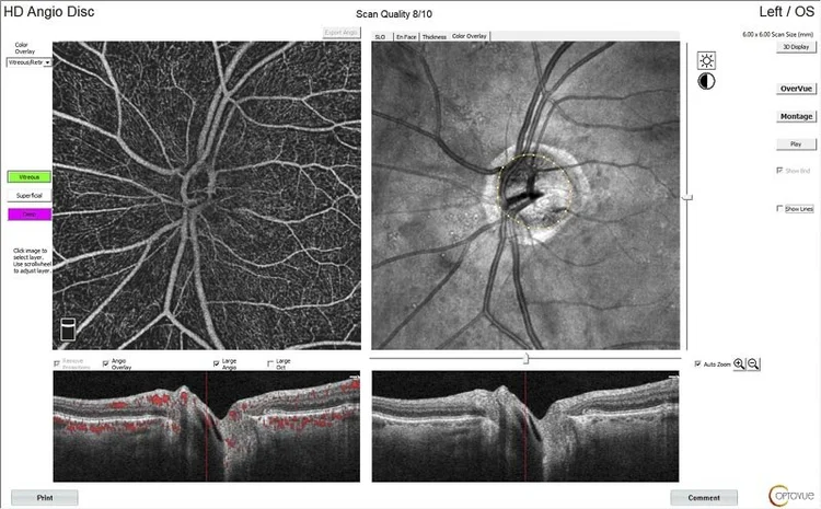 Eye Disease Assessment and Management in Stoughton, WI