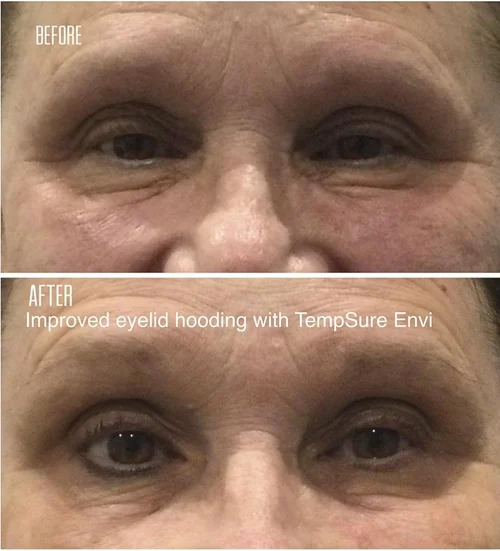 Non-Surgical Eyelid Lifting Specialists in Stoughton, WI
