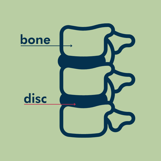 Disc Herniations: Understanding Neck Pain Caused By a Disc Problem — KOEO