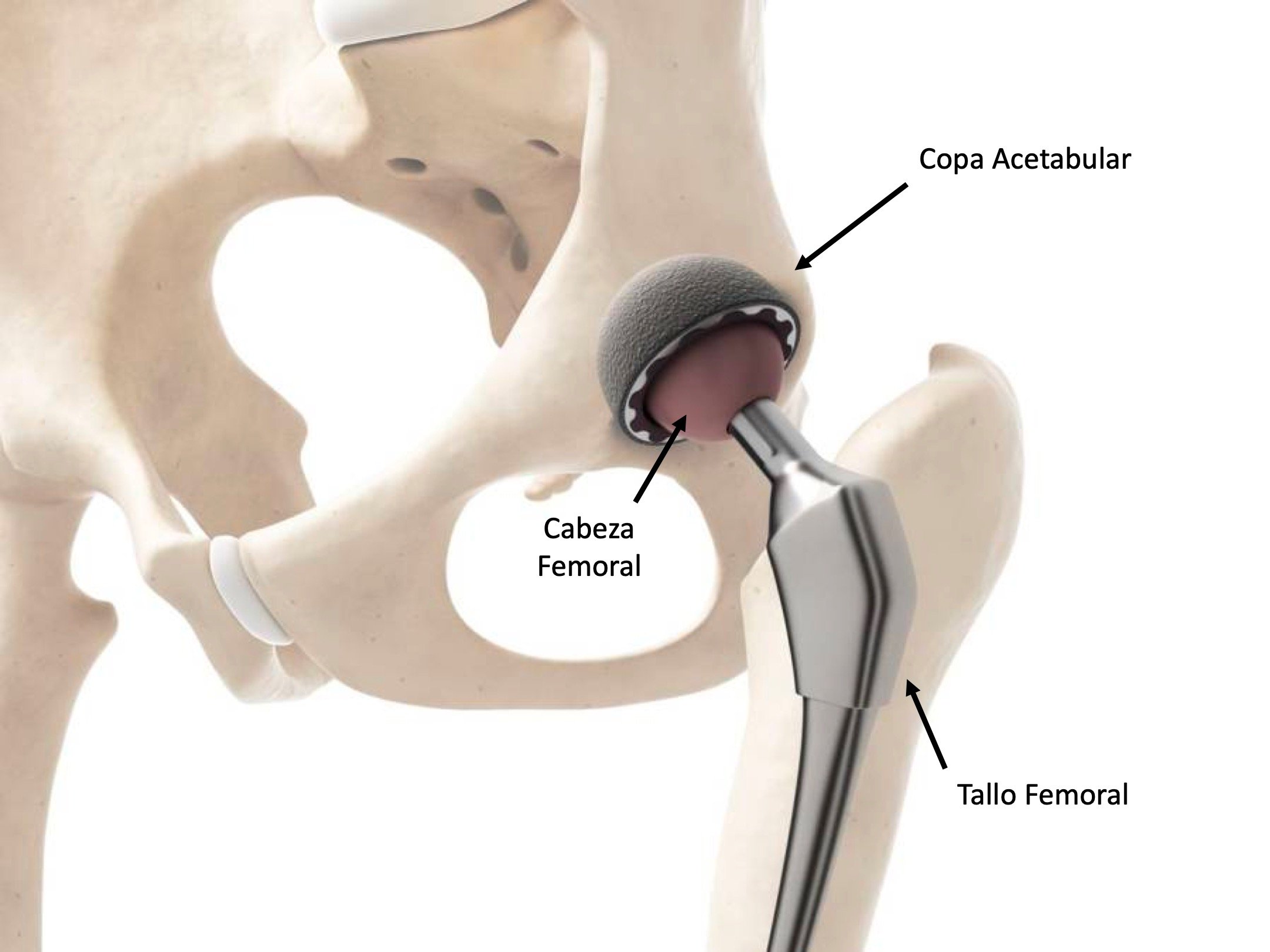 Osteoporosis fracturas de cadera — OsteoFit Ortopedia y Traumatologia ...