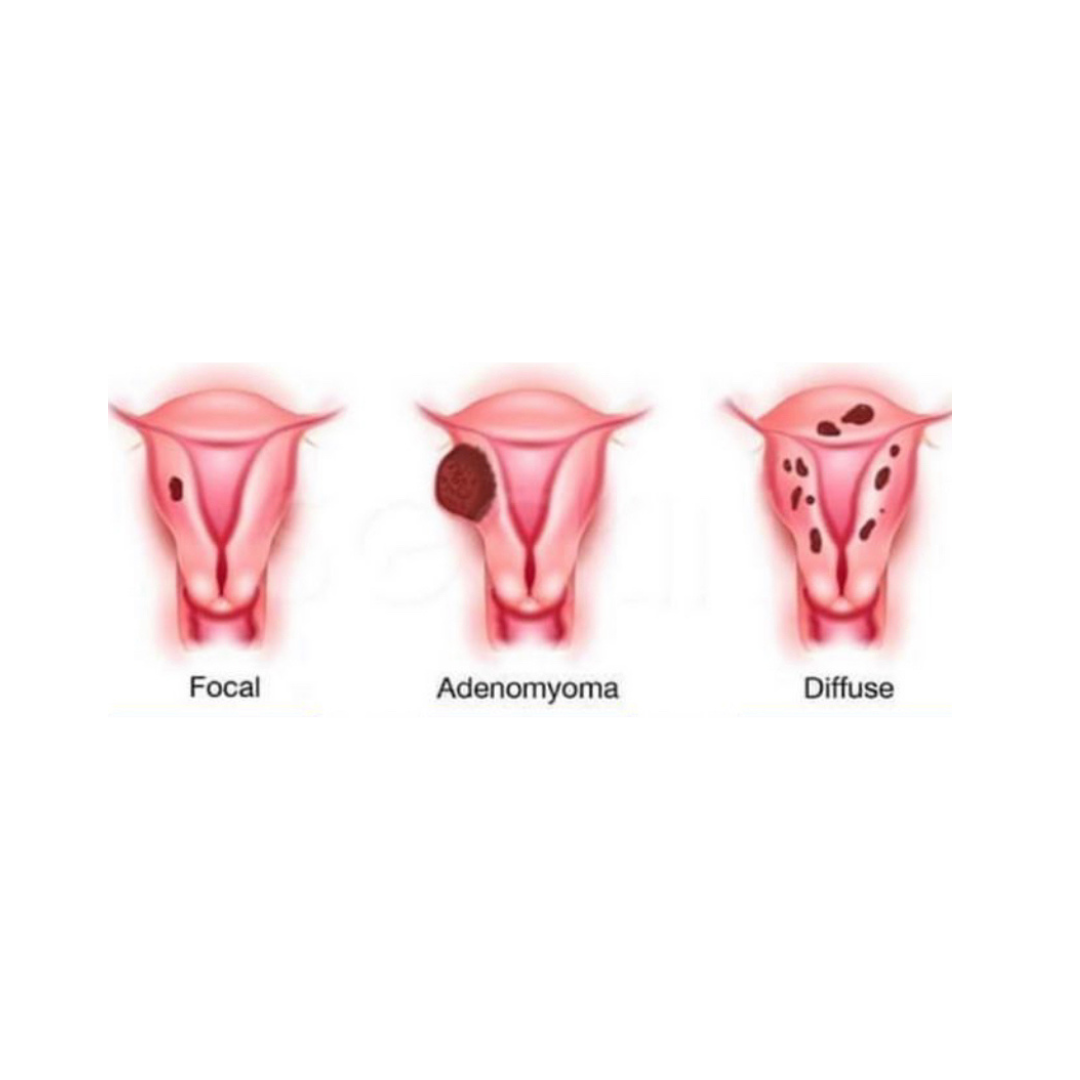 What Is Adenomyosis — The Adeno Gang