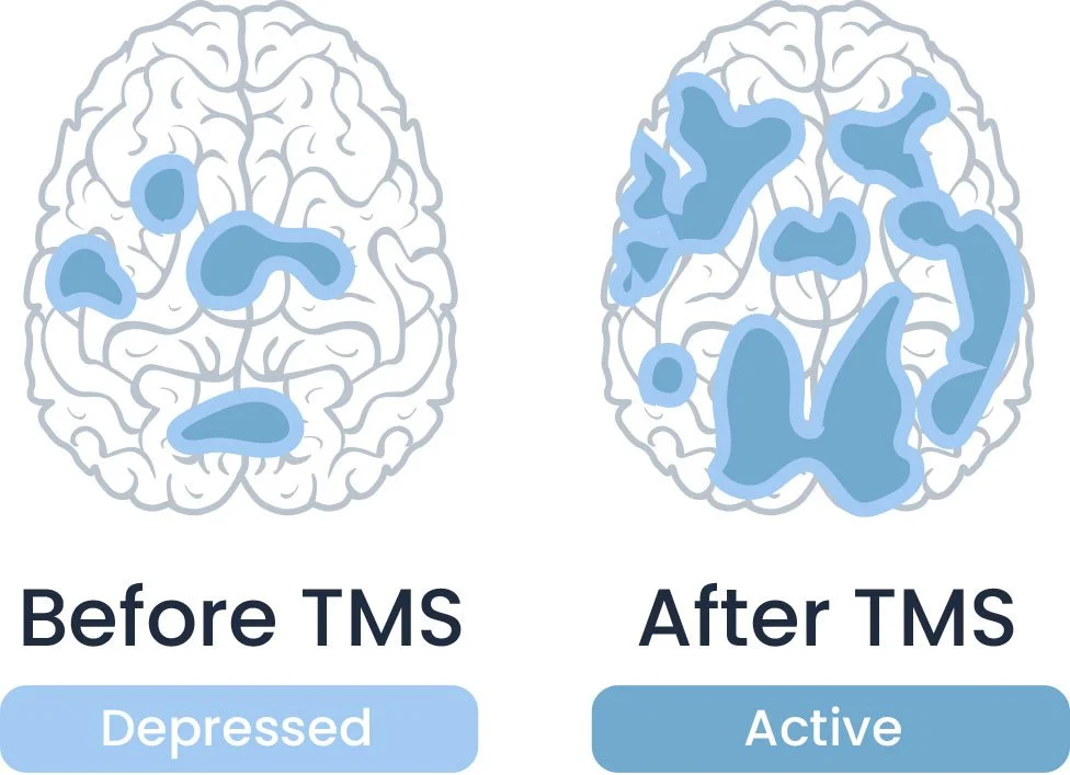 TMS Therapy Edmonton - Transcranial Magnetic Stimulation Treatment Edmonton — EnvisionMindCare