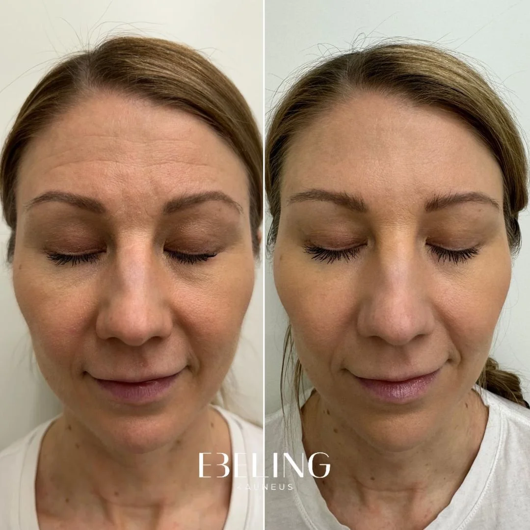 Ennen ja jälkeen | Esteettiset hoidot Helsinki — Ebeling Kauneus