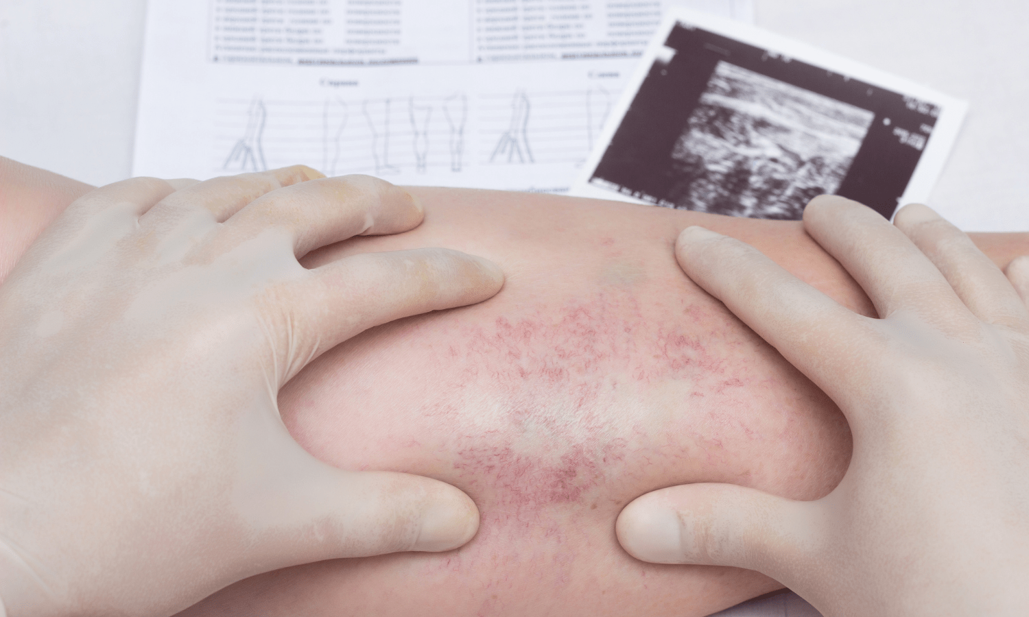 Why Do Some People Have Poor Circulation? — Indiana Vascular
