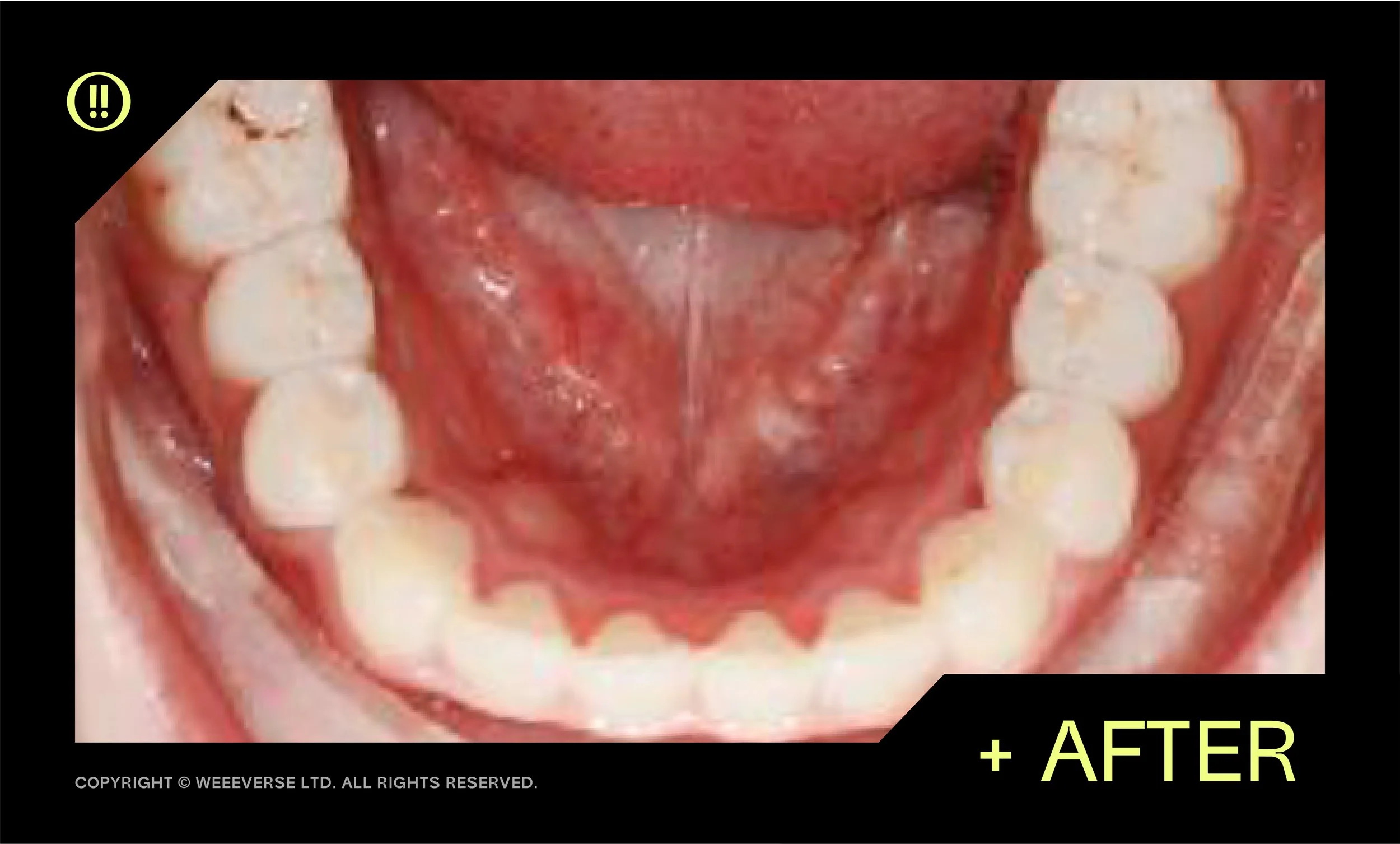 案例分享 - Weee!! 隱形牙套