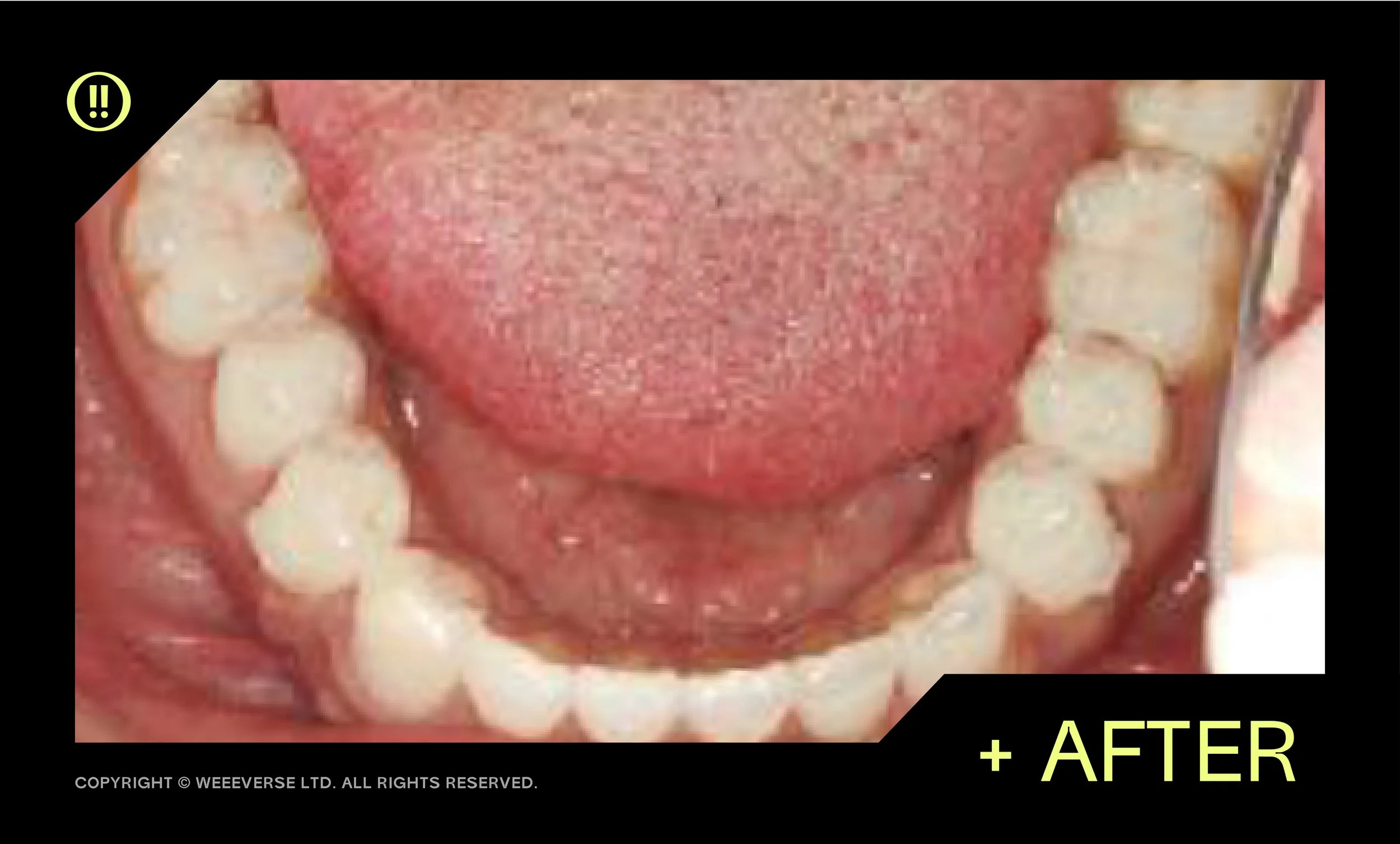 案例分享 - Weee!! 隱形牙套