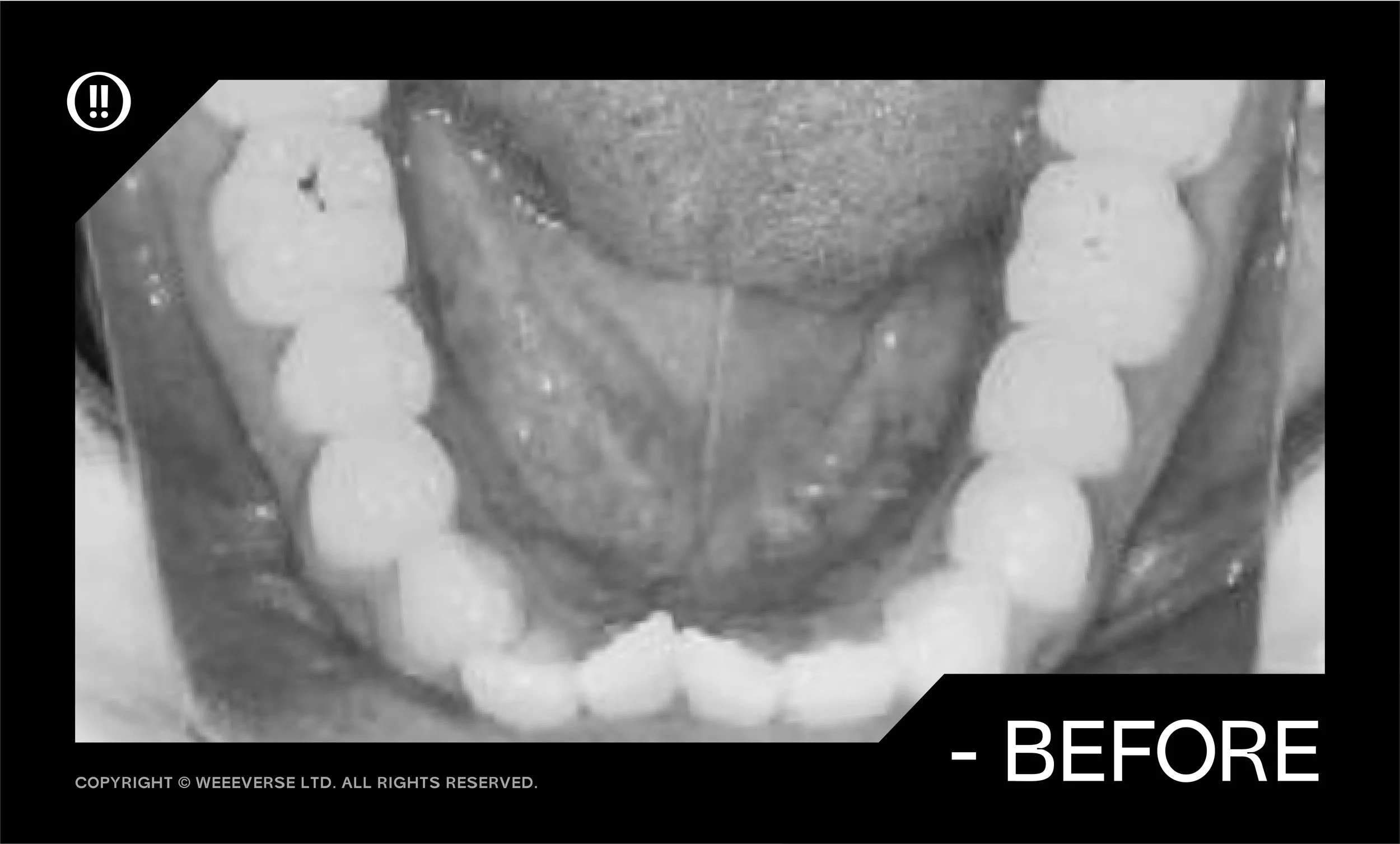 案例分享 - Weee!! 隱形牙套