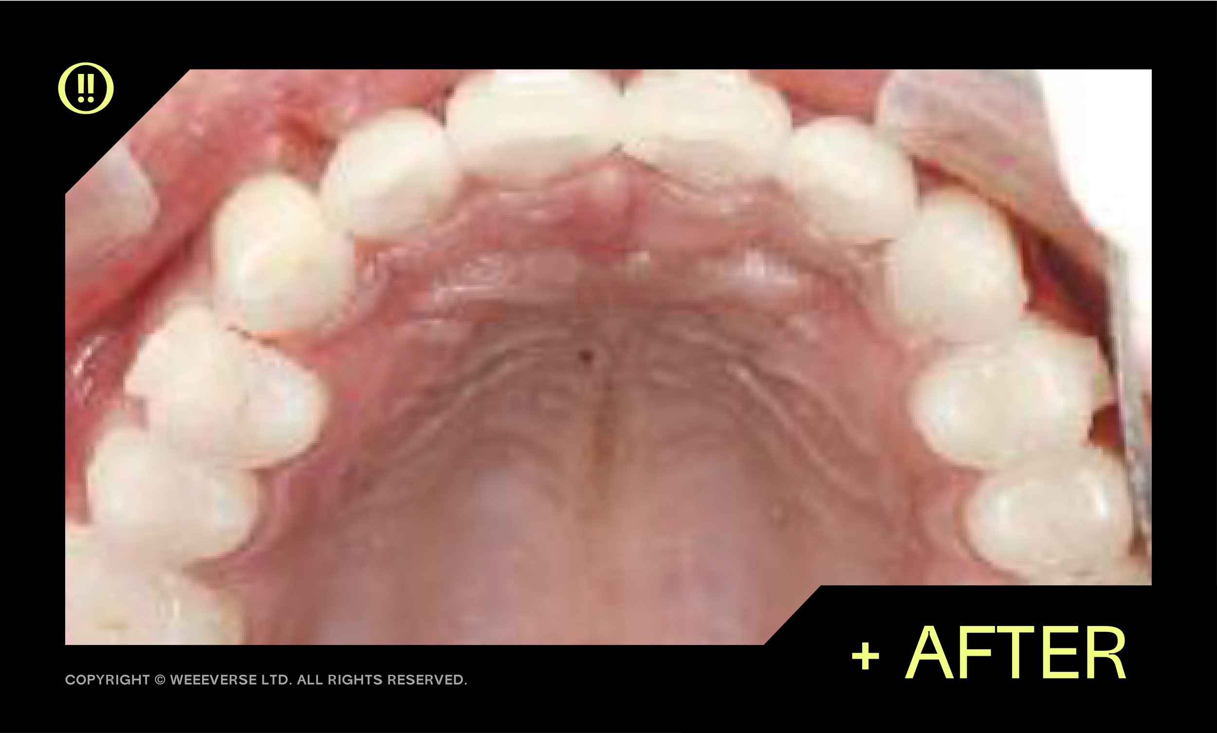 案例分享 - Weee!! 隱形牙套