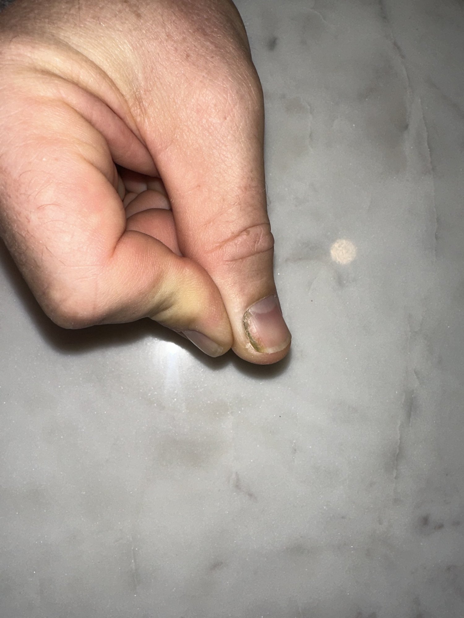 Green Nail Syndrome Treatment in Katy and Memorial Houston | Dr. Ashley ...