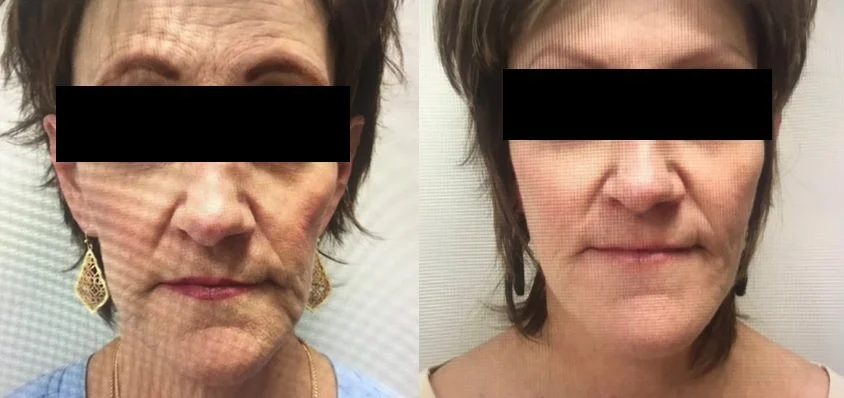 Houston Sculptra Injectable Treatment