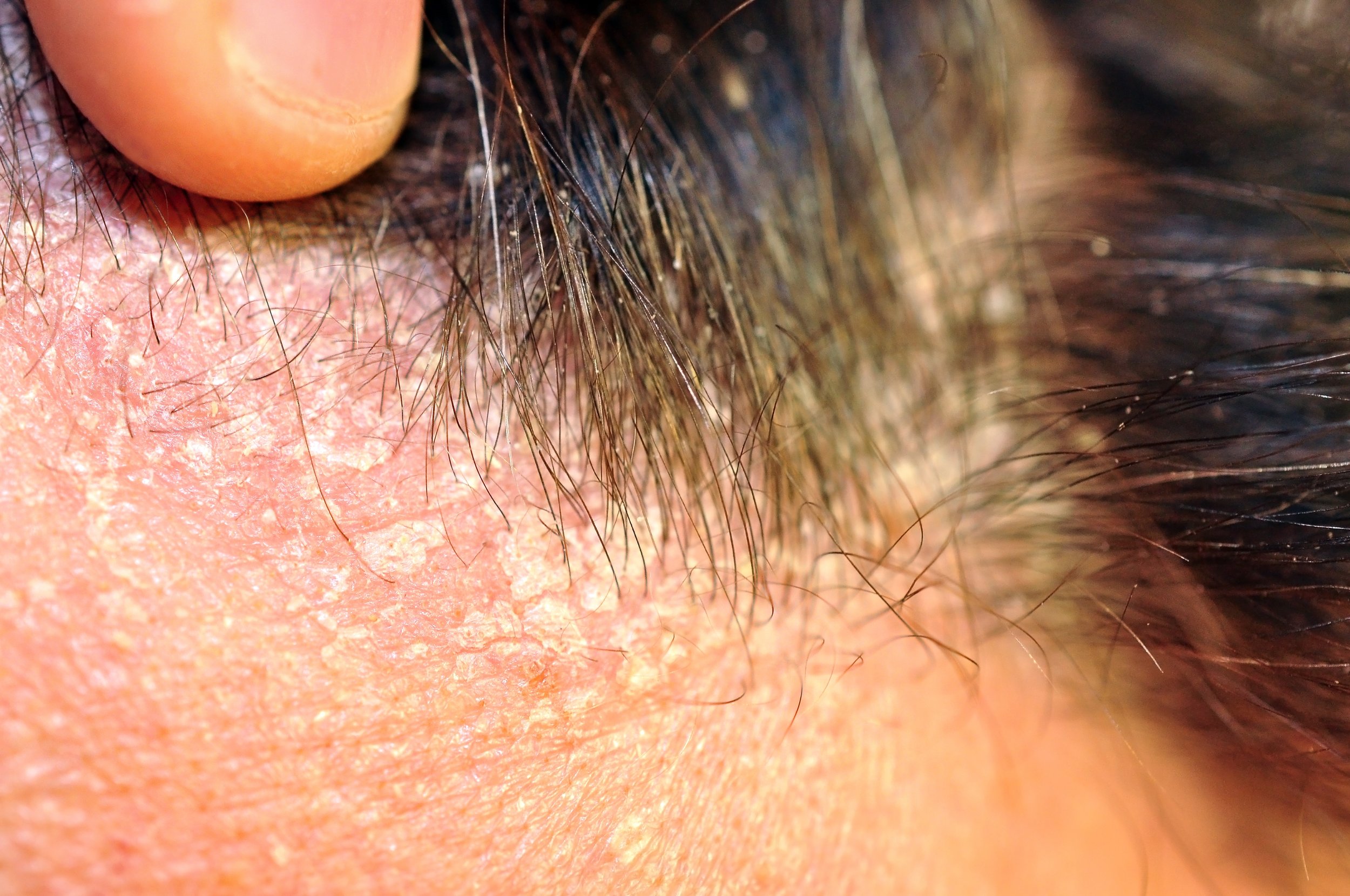 "Perioral and Seborrheic Dermatitis Treatment in Katy and Memorial ...