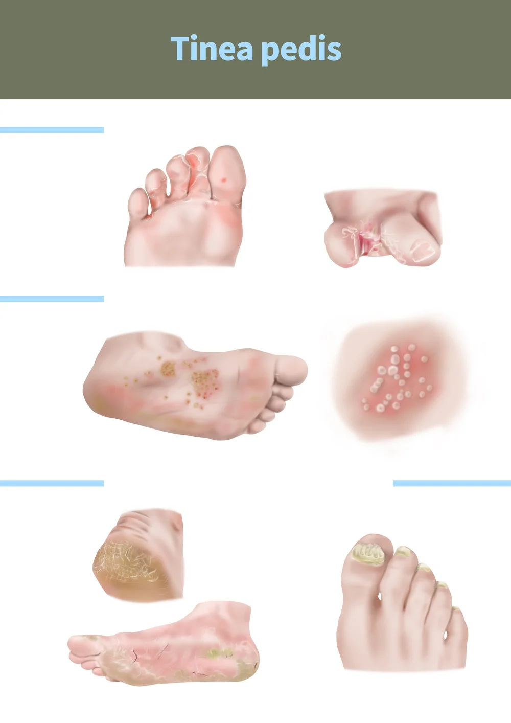 Athlete’s Foot Symptoms & Treatment | Village Dermatology in Katy, TX