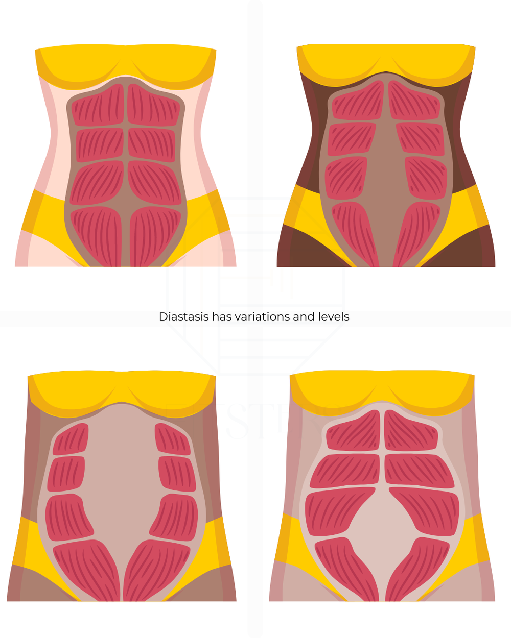 Diastasis rectis- What it is and how to heal it — Fitsters | Muslimah ...