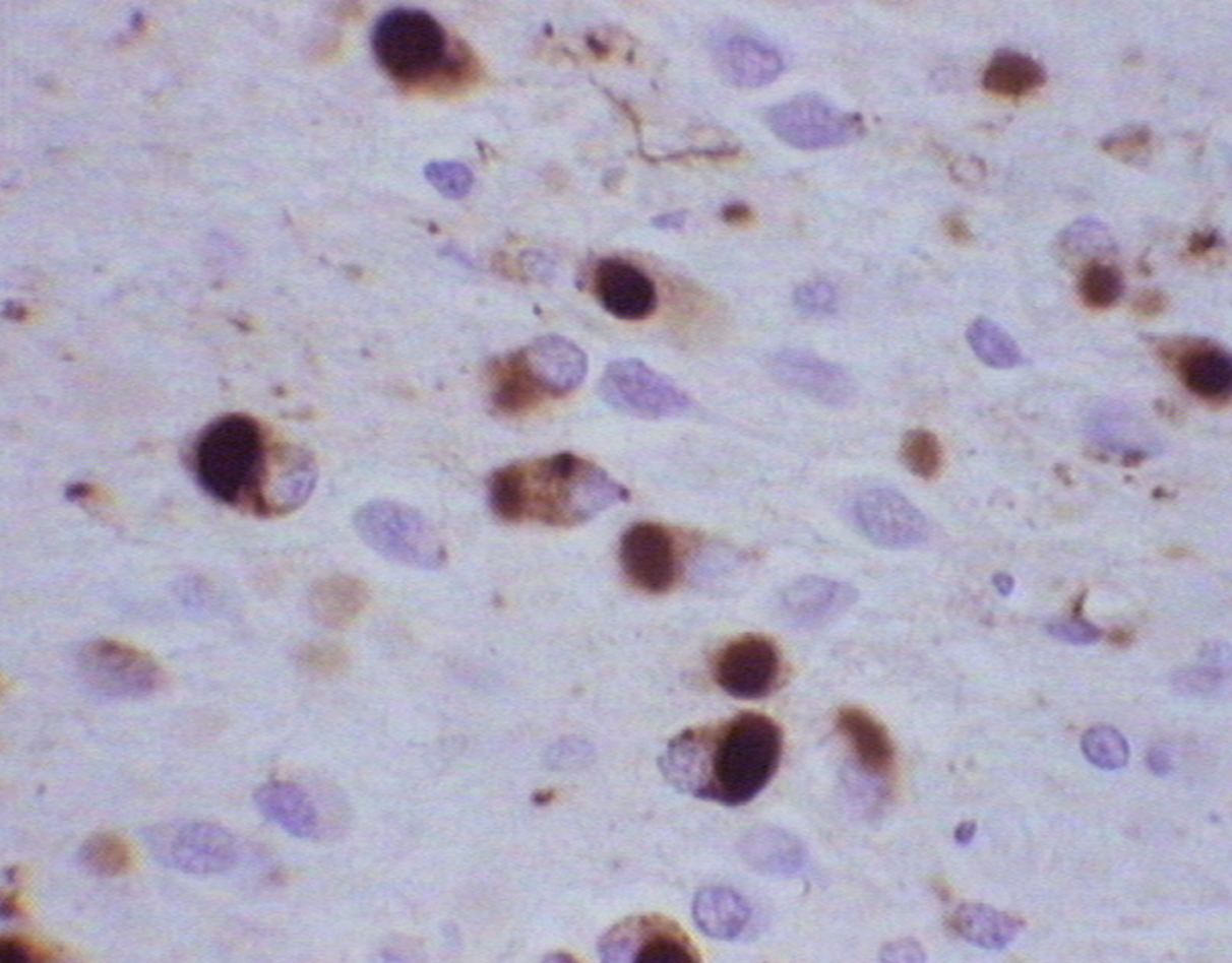 About 5 — The Pick's Disease International Consortium