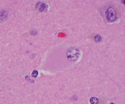 About 5 — The Pick's Disease International Consortium