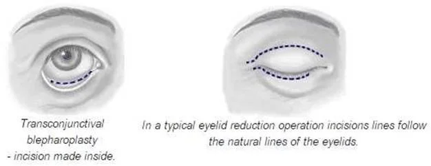 Blepharoplasty — Carrot Health