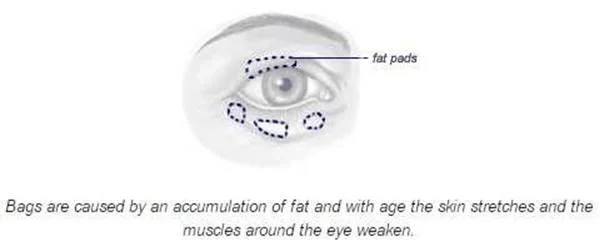 Blepharoplasty — Carrot Health