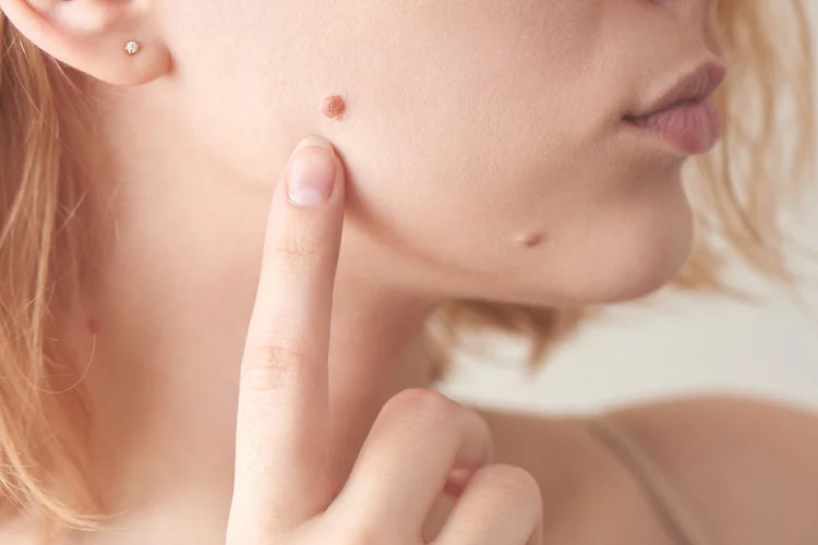 What Can Be Mistaken for Skin Cancer? Top 5 Conditions That Require a ...