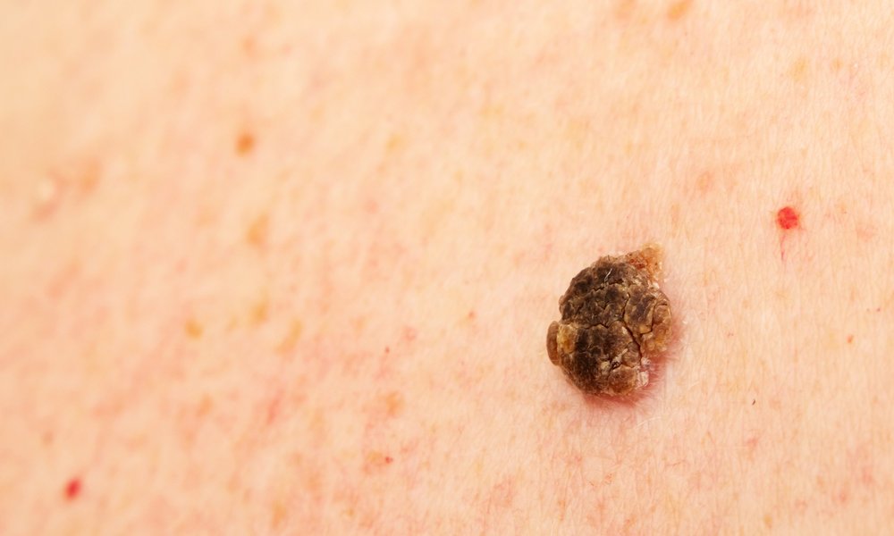 What Can Be Mistaken for Skin Cancer? Top 5 Conditions That Require a ...