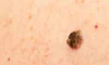 What Can Be Mistaken for Skin Cancer? Top 5 Conditions That Require a ...