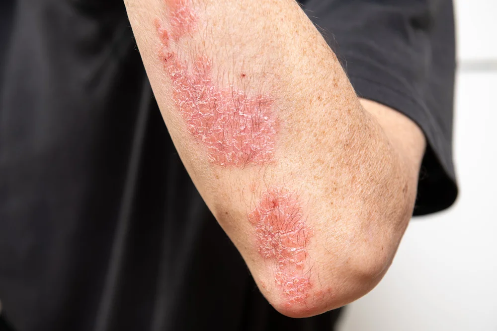 What Can Be Mistaken For Skin Cancer Top 5 Conditions That Require A