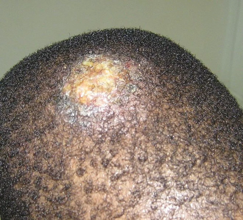 Tinea Capitis / Ringworm — Hair Medicine Institute