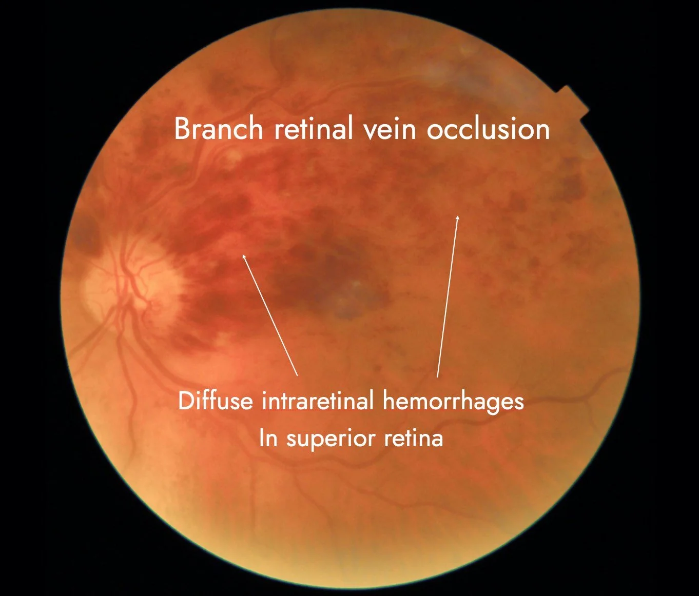 Retinal Vein Occlusion (blocked vein) | myeyespecialist