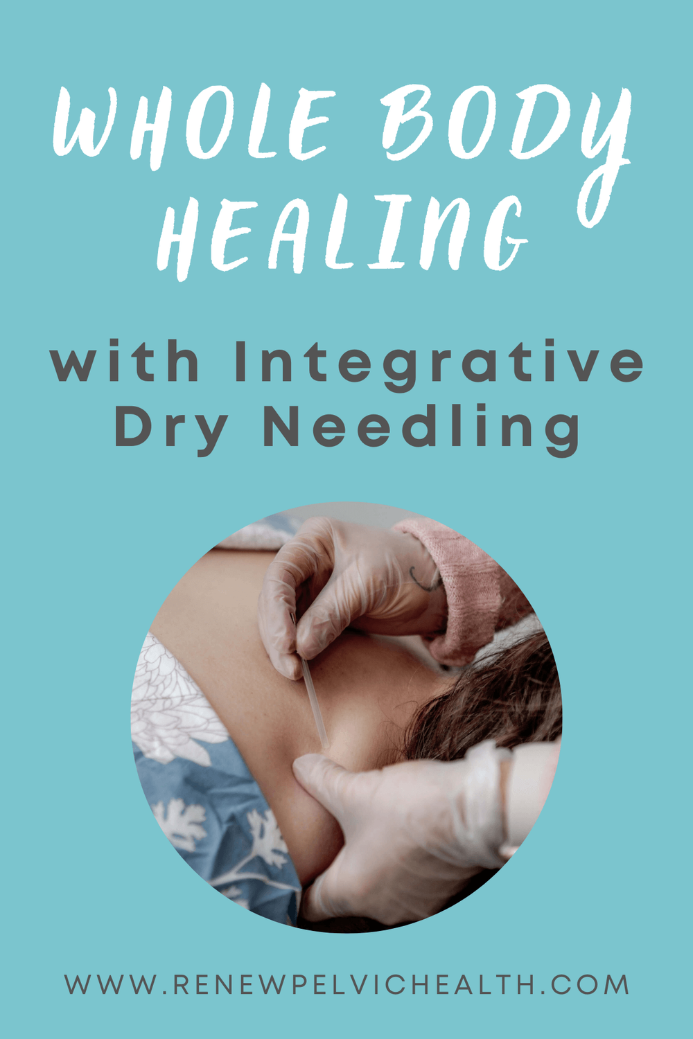 Whole Body Healing with Integrative Dry Needling — Renew Pelvic Health