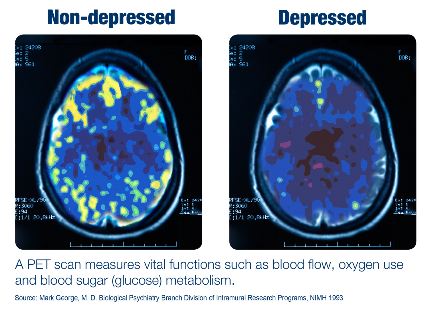 NeuroStar Transcranial Magnetic Stimulation — Changing Minds Psychiatry