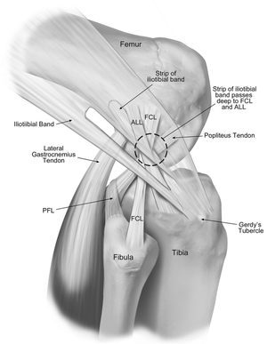 The Role of LET in ACL Surgery — Matthew Fury, MD - Shoulder, Elbow, and Sports Medicine Surgeon