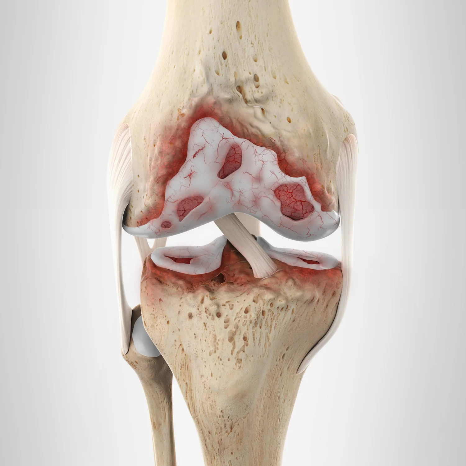 Knee Deterioration — Andy Wagener