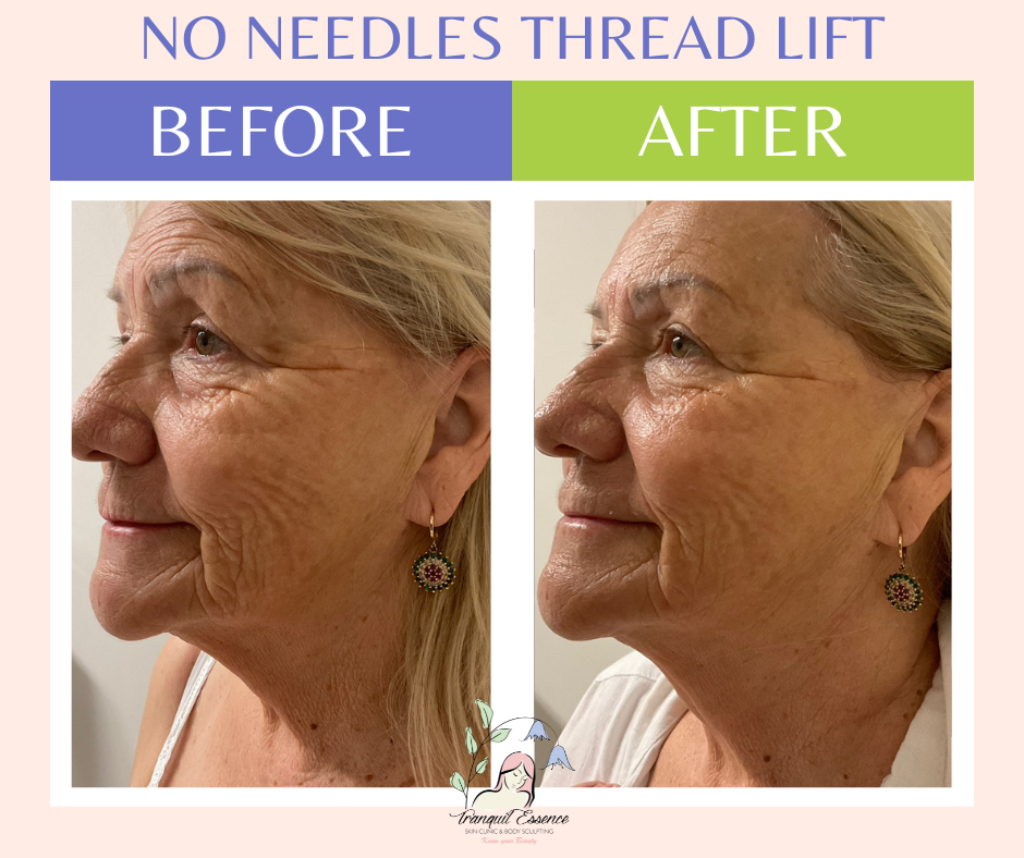 No Needles Thread Lift — Tranquil Essence