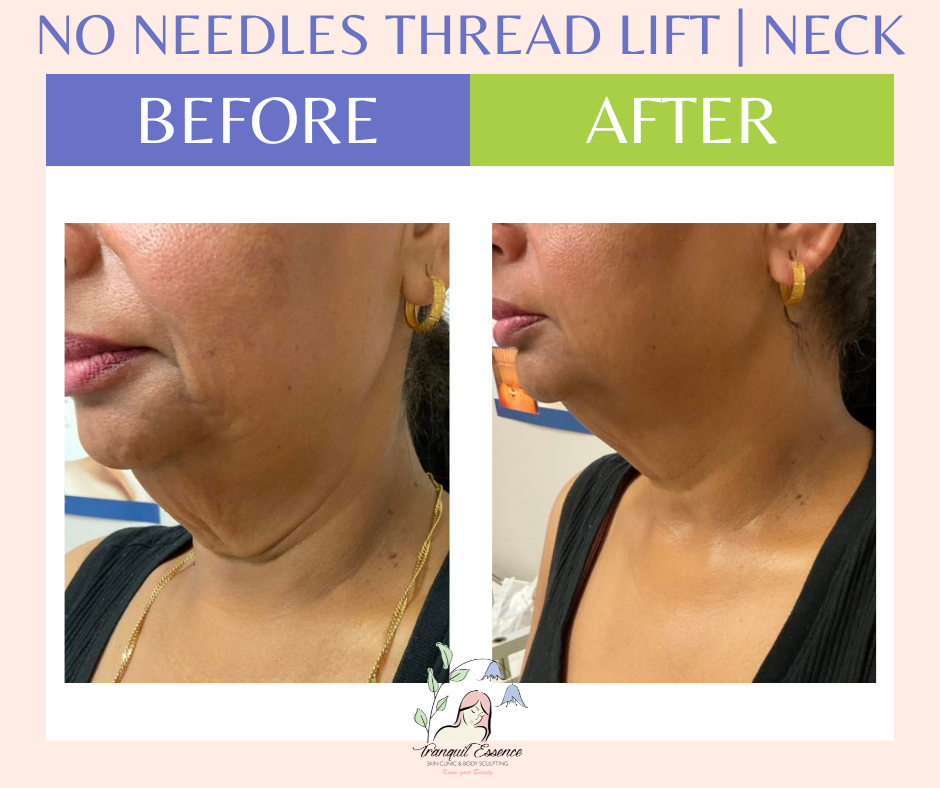 No Needles Thread Lift — Tranquil Essence