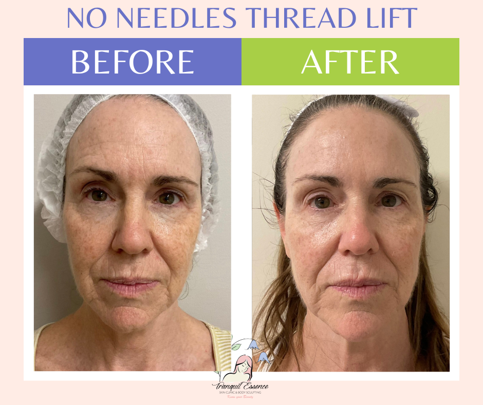 No Needles Thread Lift — Tranquil Essence