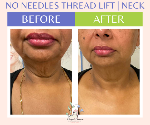No Needles Thread Lift — Tranquil Essence