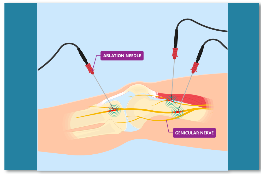 Interventional treatments — Perceptions Pain Practice