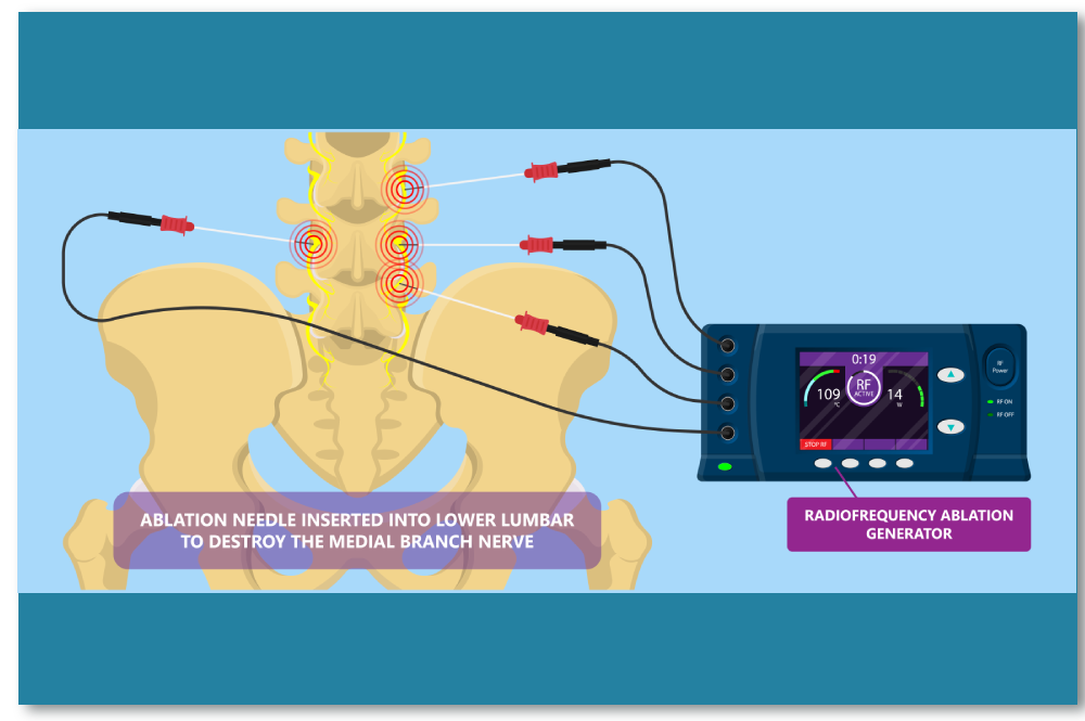 Interventional treatments — Perceptions Pain Practice