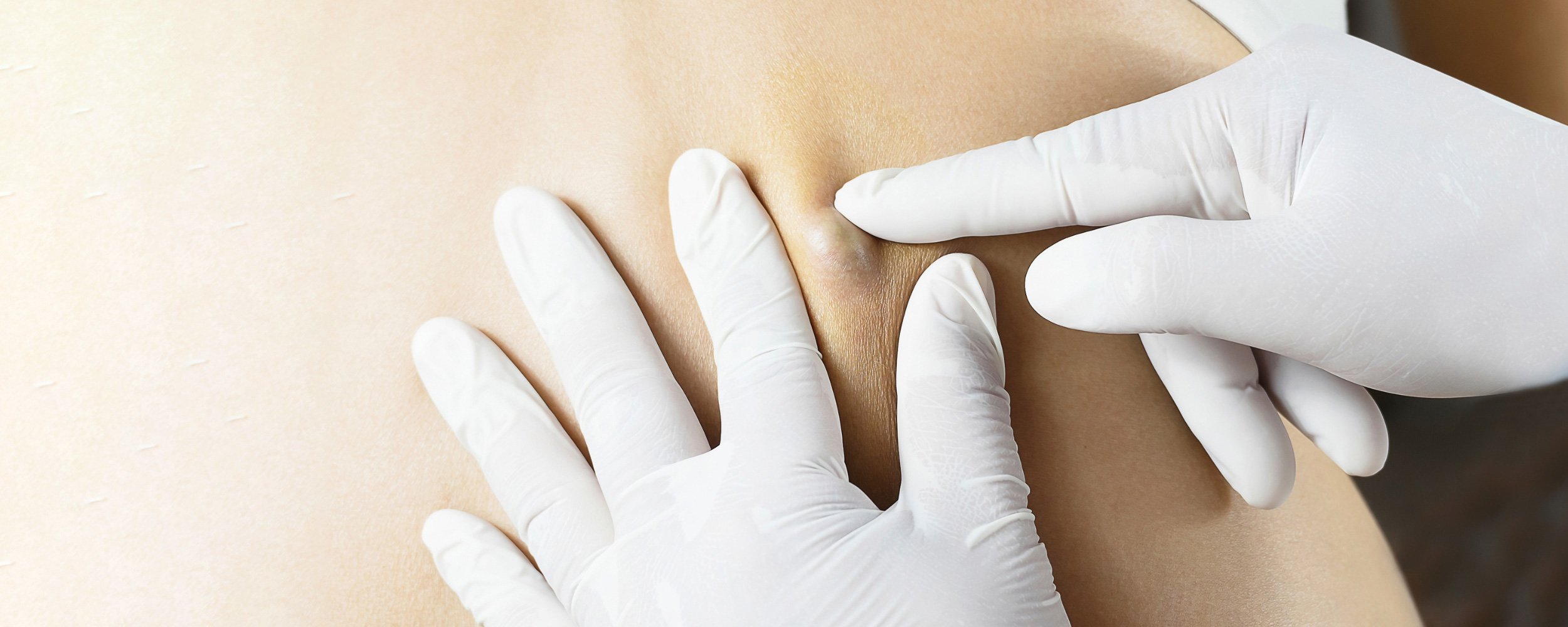 Skin Biopsy and Cyst Removal — Athena Dermatology Clinic