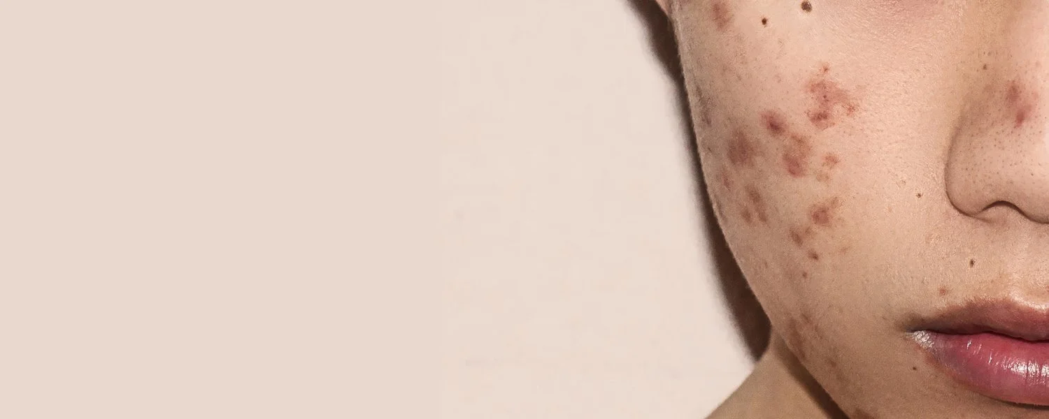 Acne and Acne Scarring Treatments — Athena Dermatology Clinic