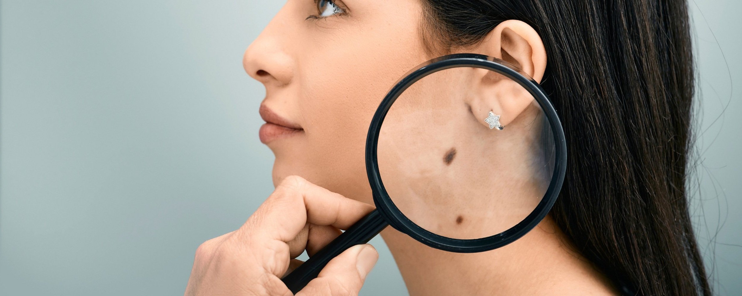 Mole Mapping and Check in Dubai — Athena Dermatology Clinic