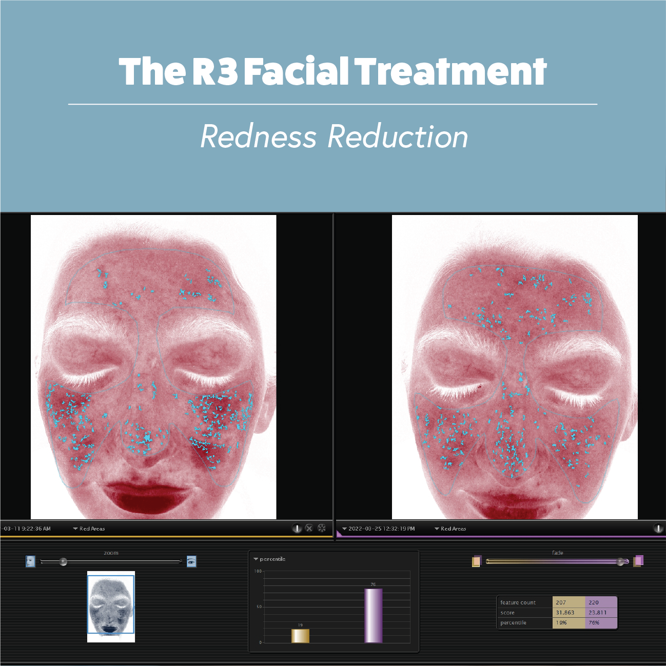 DermaPen® Microneedling | Collagen Induction Therapy | Non-Invasive ...