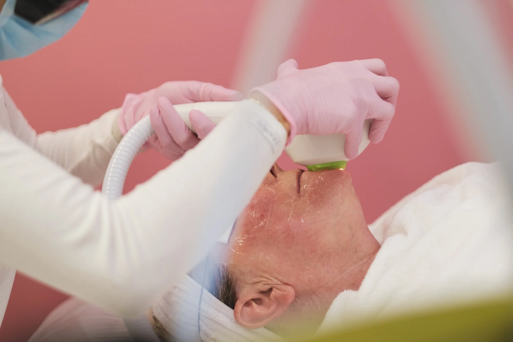 Venus IPL Photo Facial — Marshmallow Laser & Skin Centre | Laser and ...